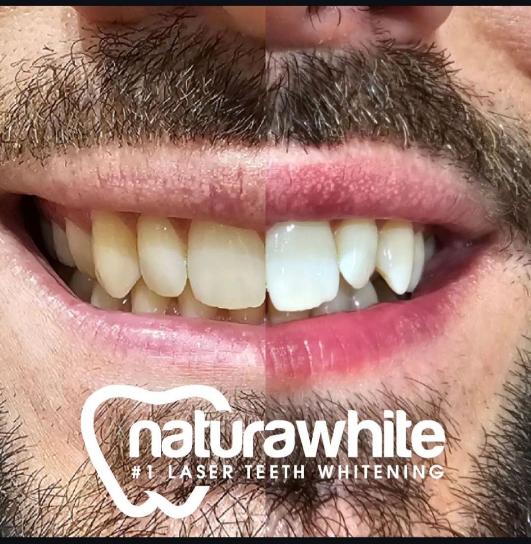 Pearly White Teeth Whitening – Arora Hair and Beauty